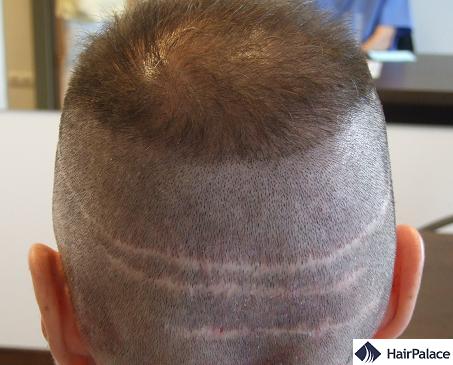 Hair Transplant Surgery: Procedures, Average Cost, Recovery, and More