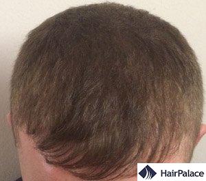 Hair transplant results - HairPalace