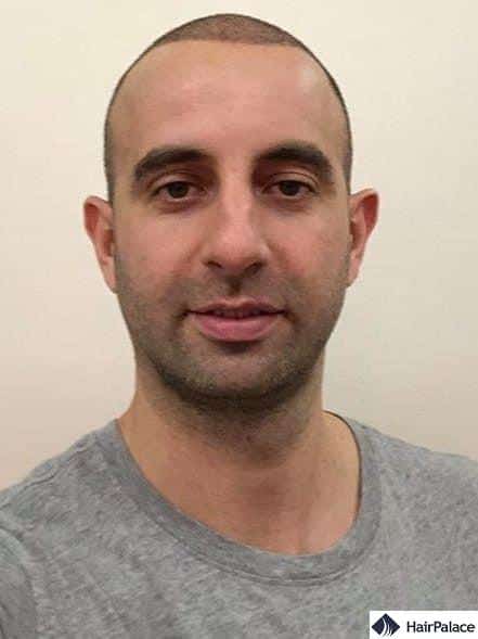 How To Reduce Swelling After Hair Transplant