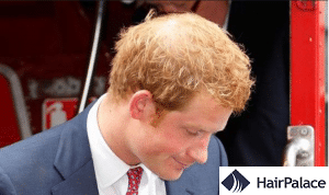 A mature hairline: what is it, how to prevent or treat it?