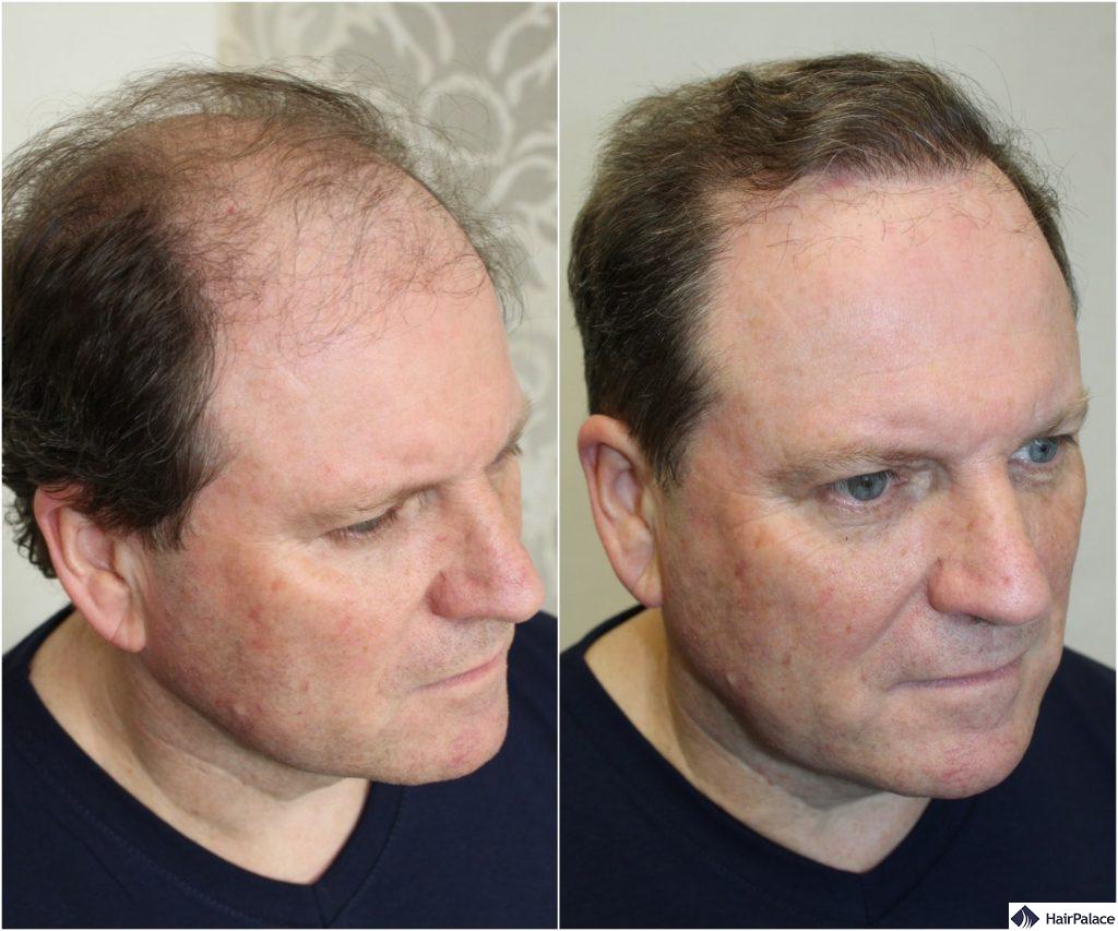 Three Hair Transplants, an Incredible Transformation – Derek’s Procedure