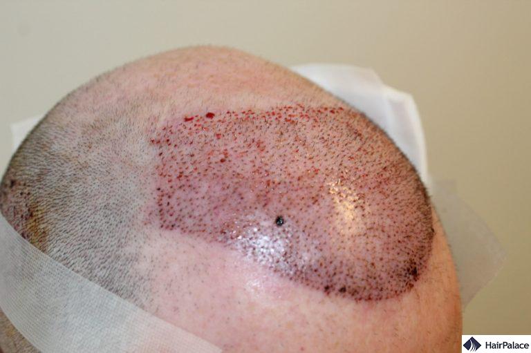 Three Hair Transplants, an Incredible Transformation – Derek’s Procedure