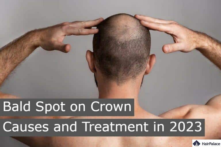 Bald Spot on Crown | How to Spot & Stop It [2024]