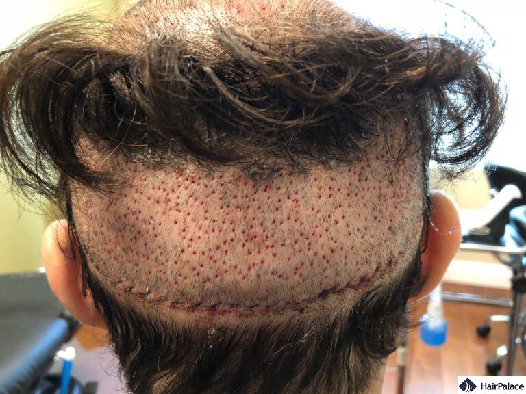 Are Hair Plugs Still Used in 2025?