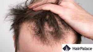 Early Signs of Balding | How to Spot and Stop Them in 2024?