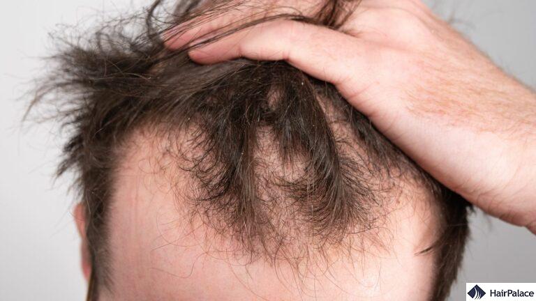 Early Signs of Balding | How to Spot and Stop Them in 2024?