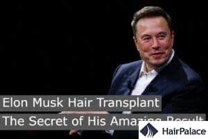 Elon Musk Hair Transplant: The Secret of His Amazing Result