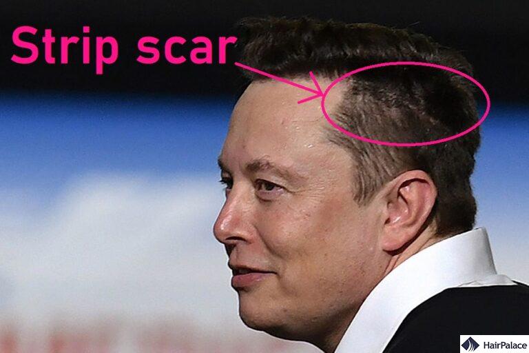 Elon Musk Hair Transplant: The Secret of His Amazing Result