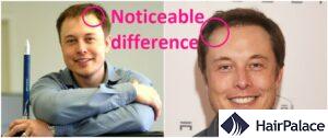 Elon Musk Hair Transplant: The Secret of His Amazing Result
