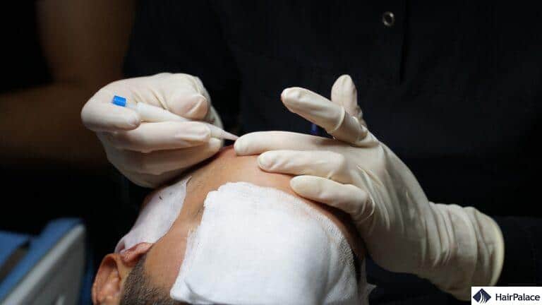 DHI Hair Transplant UK | Guide 2024 | Hairpalace Clinic