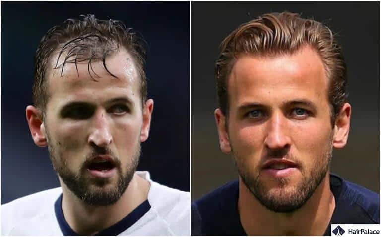 Harry Kane Hair Transplant: How Much did It Cost?