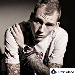 Machine Gun Kelly Hair Transplant: FUT or FUE?