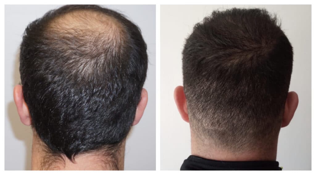 Crown Hair Transplant Timeline: What You Should Expect