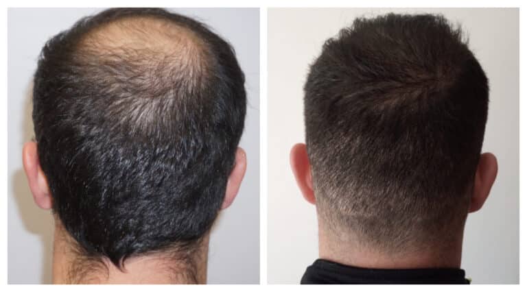 Crown Hair Transplant Timeline: What You Should Expect