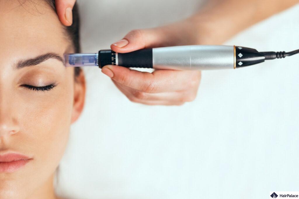 Microneedling for Hair Loss: Does it Actually Work?