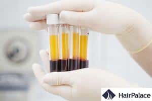 PRF Hair Treatment: Everything You Should Know in 2025