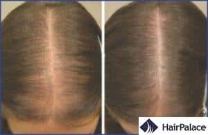 Topical Finasteride for Hair Loss: Efficacy, Side Effects and Results