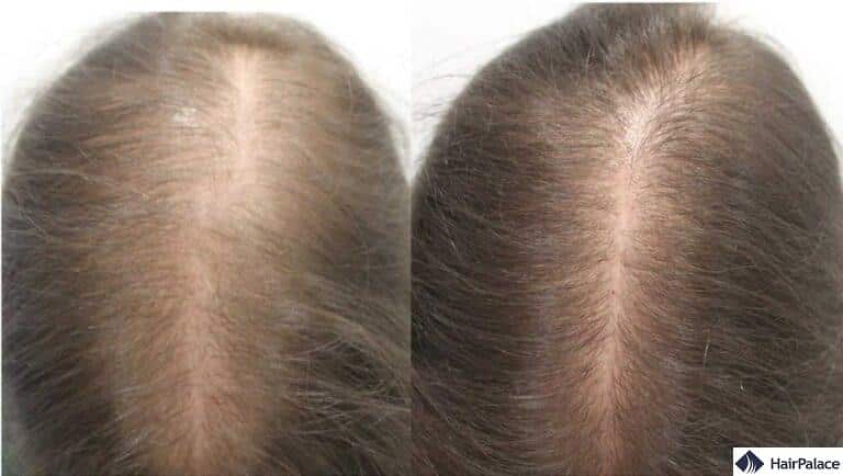 Topical Finasteride for Hair Loss: Efficacy, Side Effects and Results