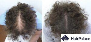 Topical Finasteride for Hair Loss: Efficacy, Side Effects and Results