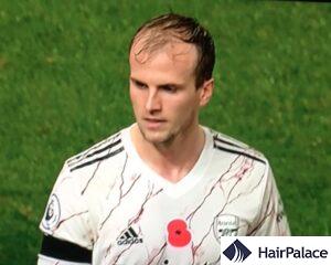 Rob Holding Hair Transplant: Cost & Results