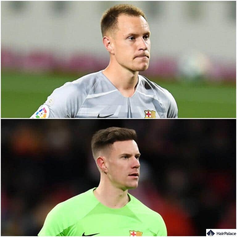 Ter Stegen Hair Transplant: What is the truth?