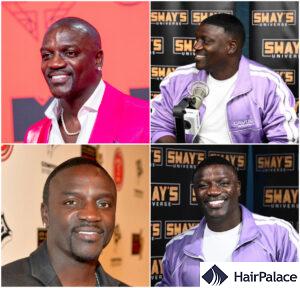 Akon Hair Transplant: What Went Wrong?