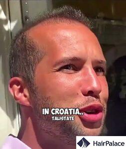 Tristan Tate Har Transplant: Did it Happen?