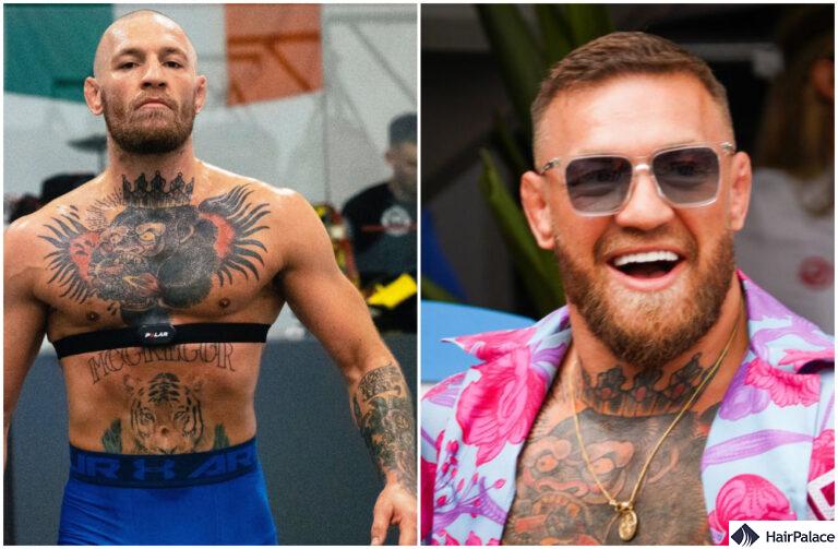 Conor McGregor Hair Transplant | His Fight Against Hair Loss