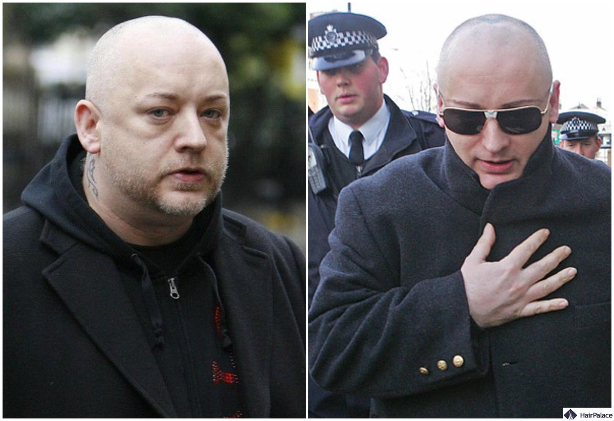 Boy George Hair Transplant: What You Must Know