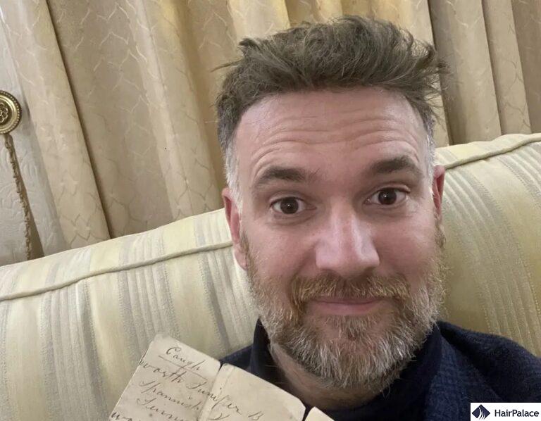 Charles Hanson Hair Transplant: Stunning Transformation!