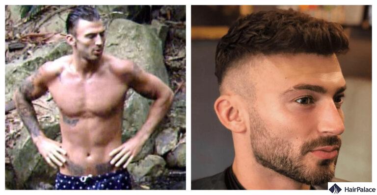 The Full Jake Quickenden Hair Transplant Story