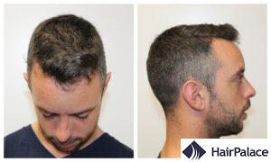 Norwood Scale: Stages, Causes & Treatments - HairPalace Clinic