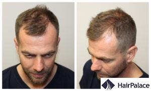 Norwood Scale: Stages, Causes & Treatments - HairPalace Clinic