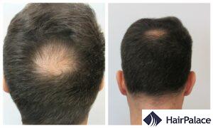 Norwood Scale: Stages, Causes & Treatments - HairPalace Clinic