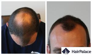 Norwood Scale: Stages, Causes & Treatments - HairPalace Clinic