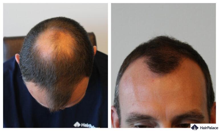 Norwood Scale: Stages, Causes & Treatments - HairPalace Clinic