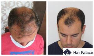 Norwood Scale: Stages, Causes & Treatments - HairPalace Clinic