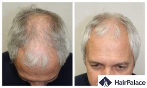 Norwood Scale: Stages, Causes & Treatments - HairPalace Clinic