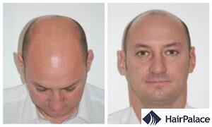 Norwood Scale: Stages, Causes & Treatments - HairPalace Clinic