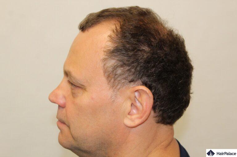 Receding Hairline Men: Signs, Causes and Treatments