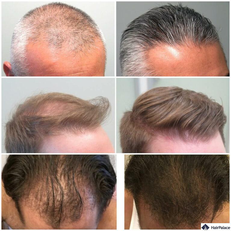Topical Finasteride vs Oral Finasteride: Is There a Difference?
