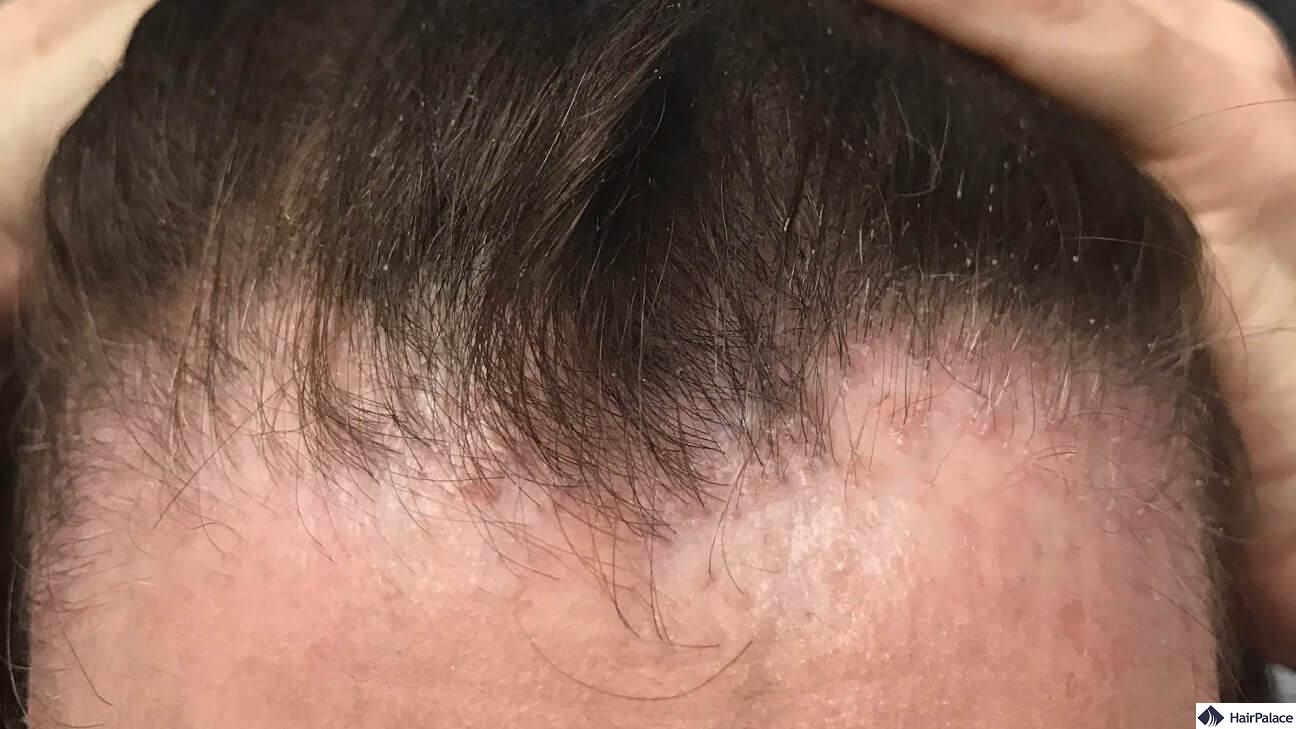 Traction Alopecia: When is it Too Late?